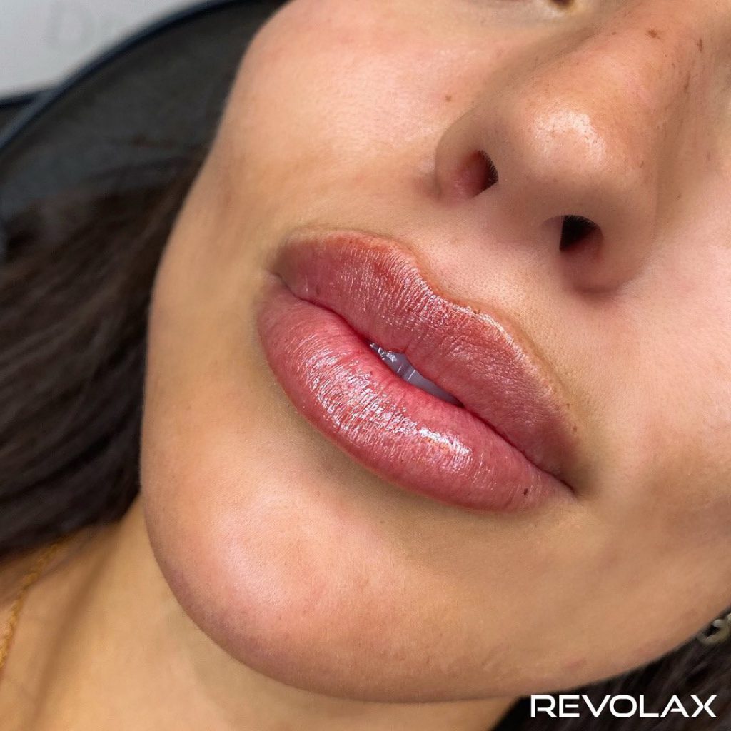 Emily Miller's Lip Filler Journey - Blog | REVOLAX UK